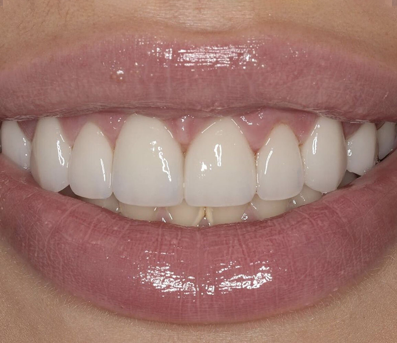 Smile Gallery - Miel Dental Aesthetics Peabody
